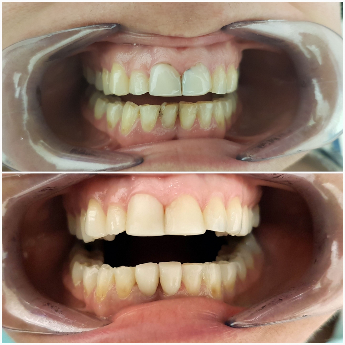 Before and After Smiles Gallery | Bespoke Dental Care - Gravesend
